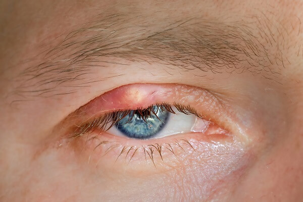 Cyst Removal and Treatment | U.S. Dermatology Partners