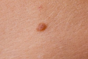 Mole Types and Treatments | U.S. Dermatology Partners