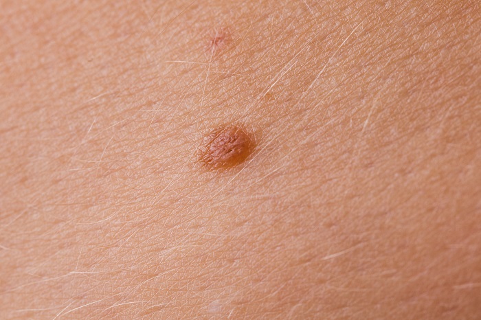 Mole Types and Treatments | U.S. Dermatology Partners