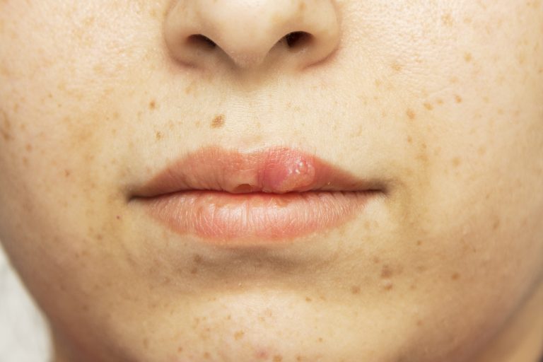 Herpes Simplex Treatment | U.S. Dermatology Partners
