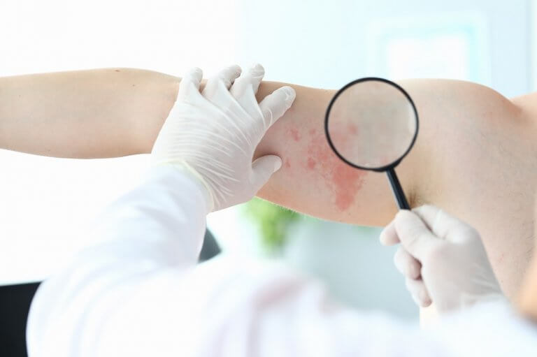 Hives Treatment and Remedies | U.S. Dermatology Partners
