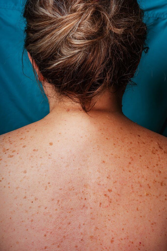 Sun-Damaged Skin Treatment | U.S. Dermatology Partners