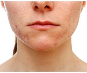 Finding The Best Acne Treatment | U.S. Dermatology Partners