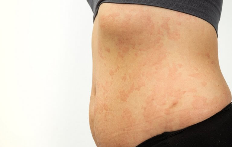 Hives Treatment and Remedies | U.S. Dermatology Partners