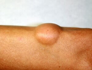 Lipoma Causes and Treatment | U.S. Dermatology Partners