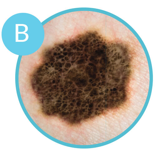 ABC(DEF)s of Identifying Melanoma | U.S. Dermatology Partners