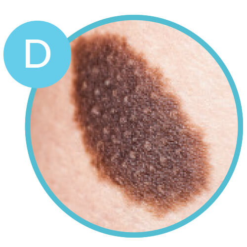 Top 5 Skin Cancer Symptoms | U.S. Dermatology Partners