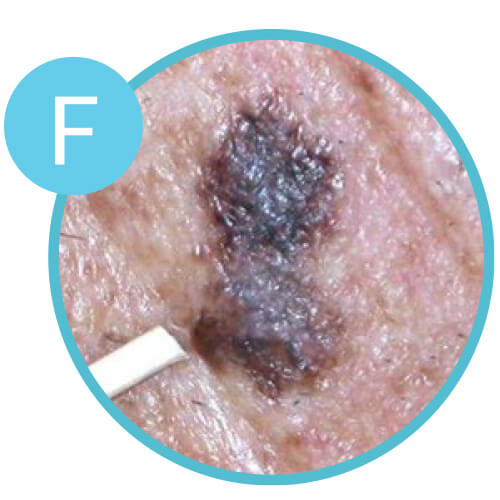 Top 5 Skin Cancer Symptoms | U.S. Dermatology Partners