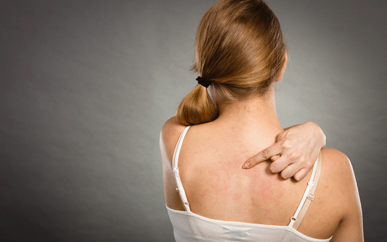 Preventing Back Acne Breakouts | U.S. Dermatology Partners