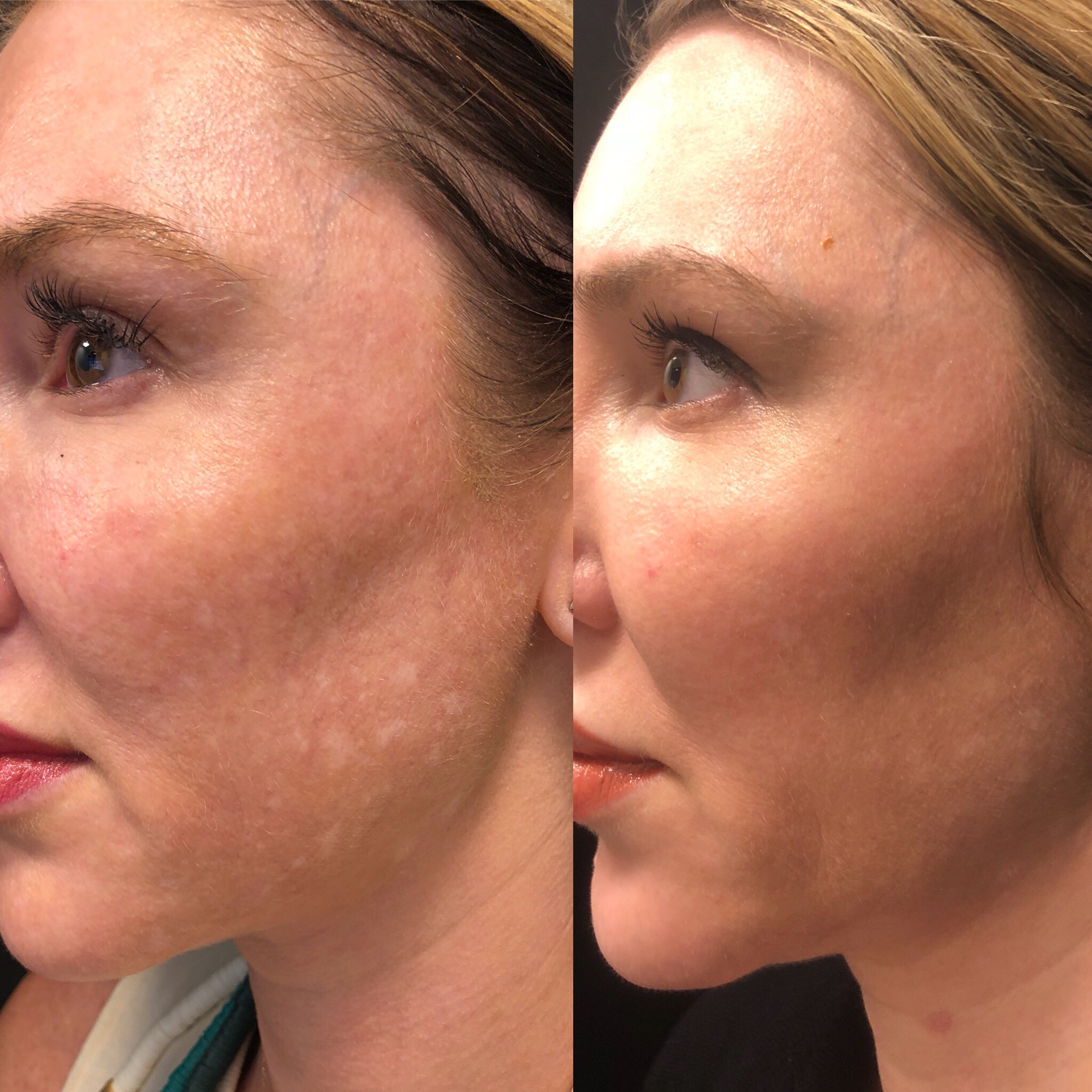 Fraxel Laser Treatment Guide | U.S. Dermatology Partners