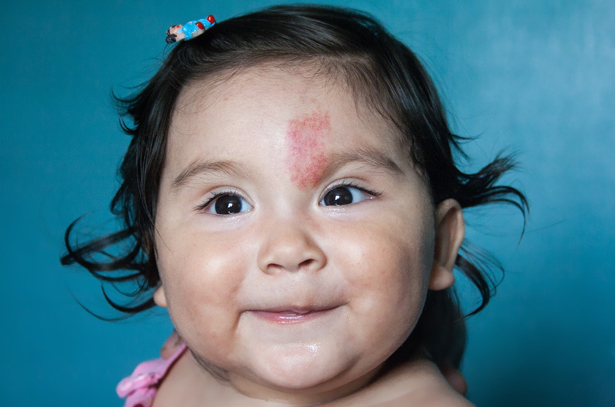Birthmarks 101 What You Need To Know U S Dermatology Partners