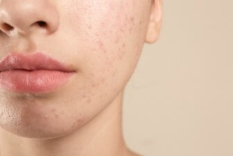 Top 5 Back to School Acne Care Tips - U.S. Dermatology Partners