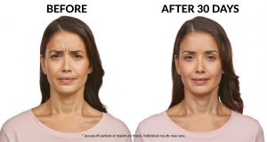 Jeuveau Injections | U.S. Dermatology Partners