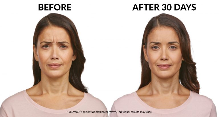 Jeuveau Injections | U.S. Dermatology Partners