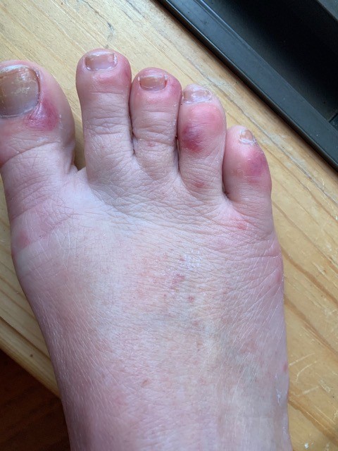 How COVID-19 Affects the Skin | U.S. Dermatology Partners