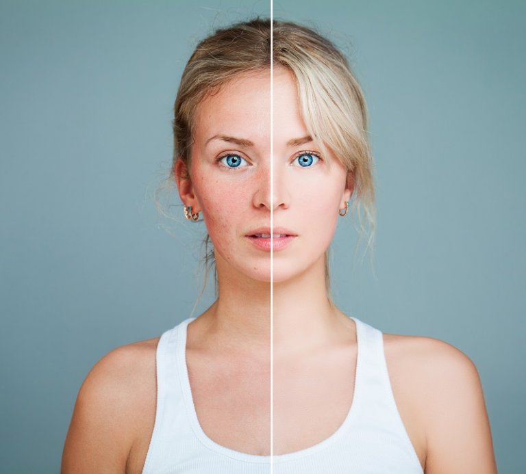 Accutane Treatment for Acne | U.S. Dermatology Partners