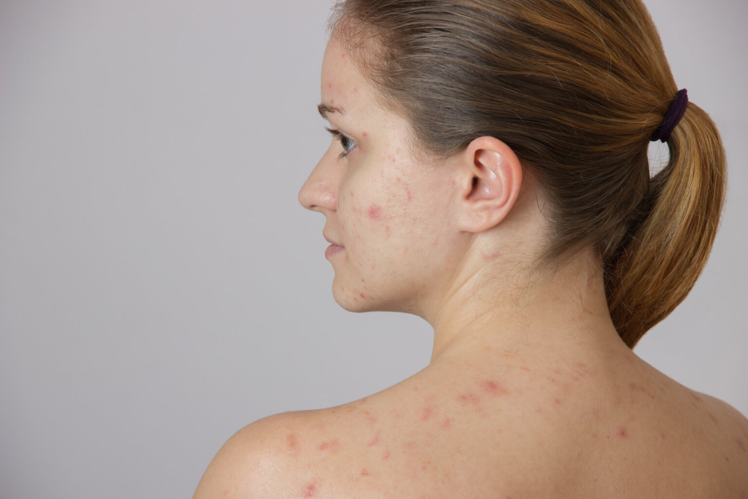 How to Get Rid of Back Acne (Bacne) | U.S. Dermatology Partners