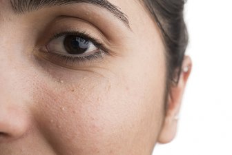 Milia: Small White Bumps | U.S. Dermatology Partners