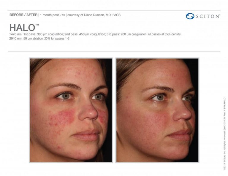 HALO Laser Skin Resurfacing | U.S. Dermatology Partners