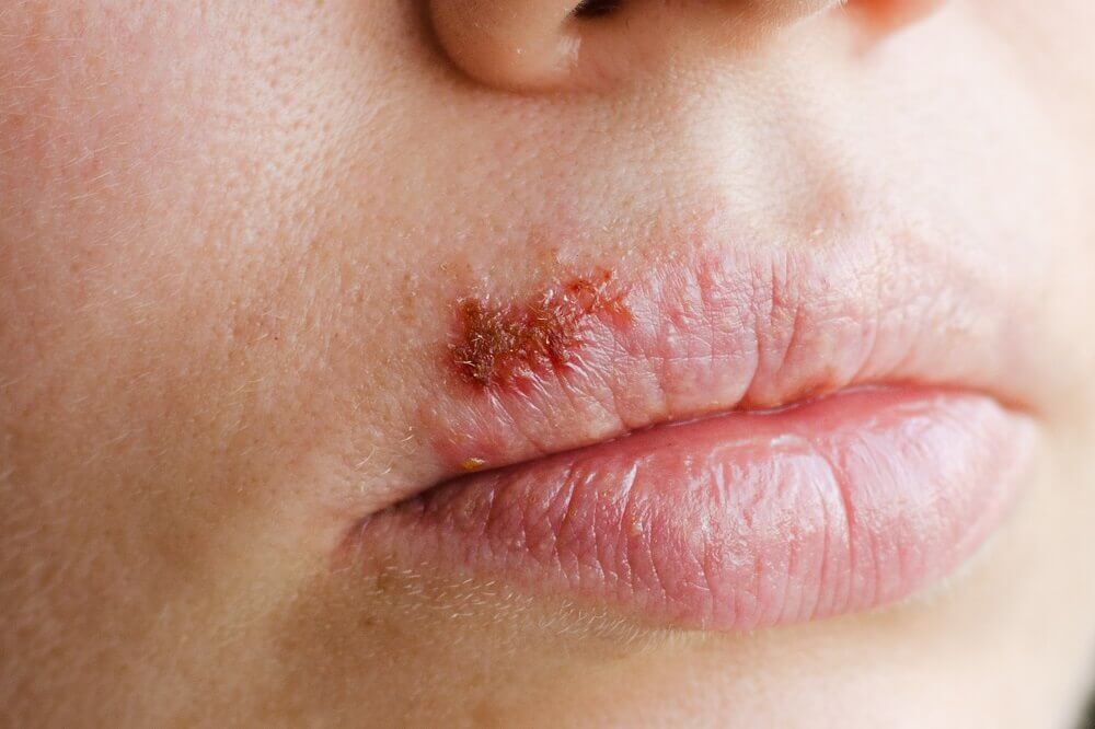 Herpes Simplex Treatment U S Dermatology Partners Herpes Simplex Treatment U S Dermatology Partners