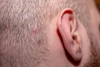 How to Get Rid of Scalp Acne - U.S. Dermatology Partners