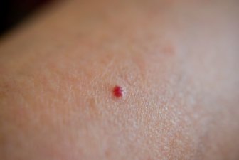 Cherry Angioma | Removal, Causes, Treatment, and Pictures