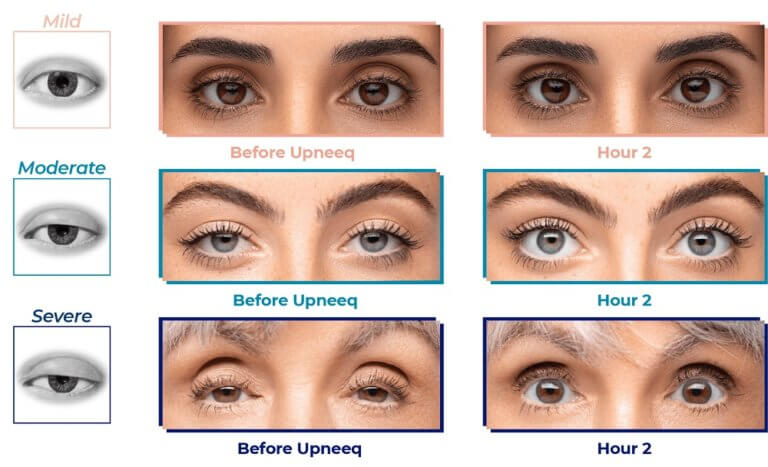 Upneeq Eye Drops | U.S. Dermatology Partners