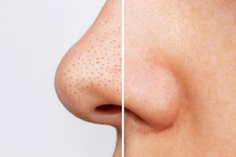 Blackheads vs. Sebaceous Filaments | U.S. Dermatology Partners