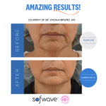 Sofwave Skin Tightening Treatment | U.S. Dermatology Partners