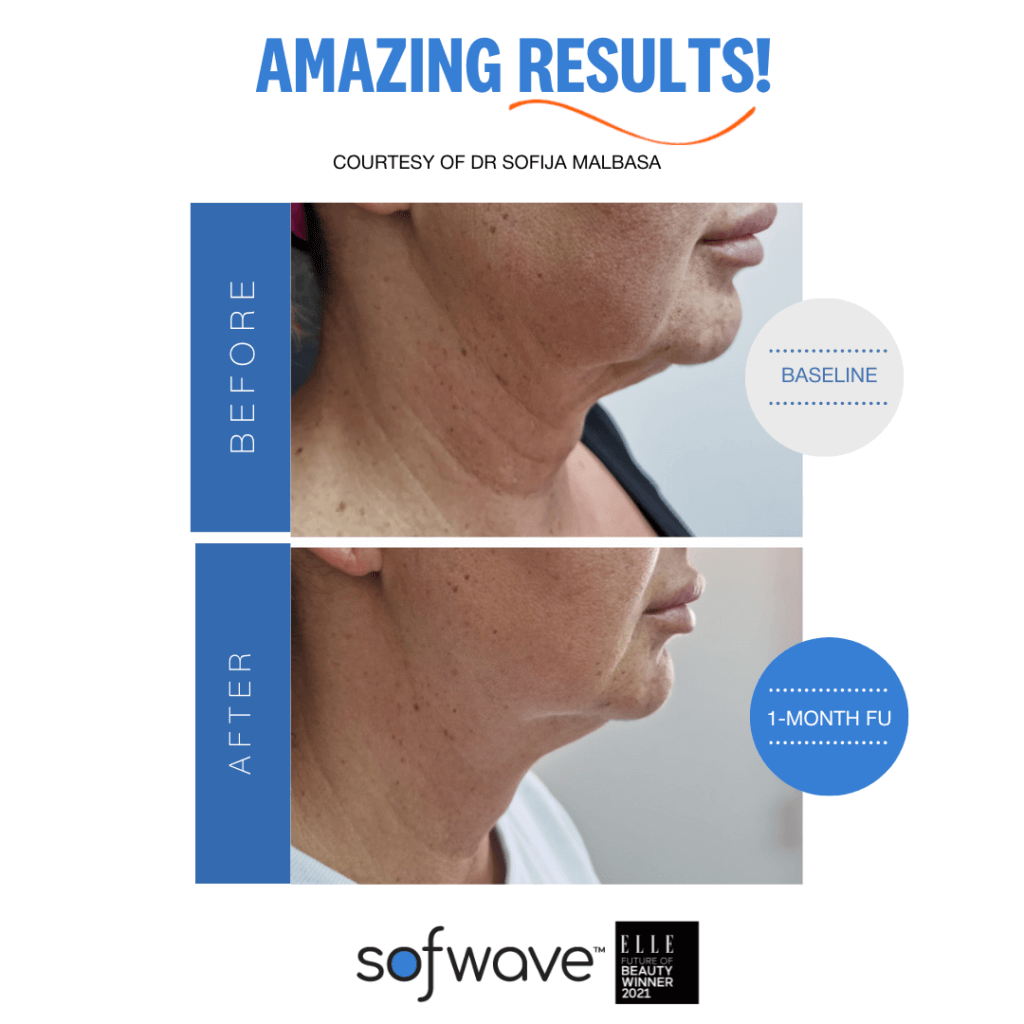 Sofwave Skin Tightening Treatment | U.S. Dermatology Partners