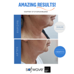 Sofwave Skin Tightening Treatment | U.S. Dermatology Partners