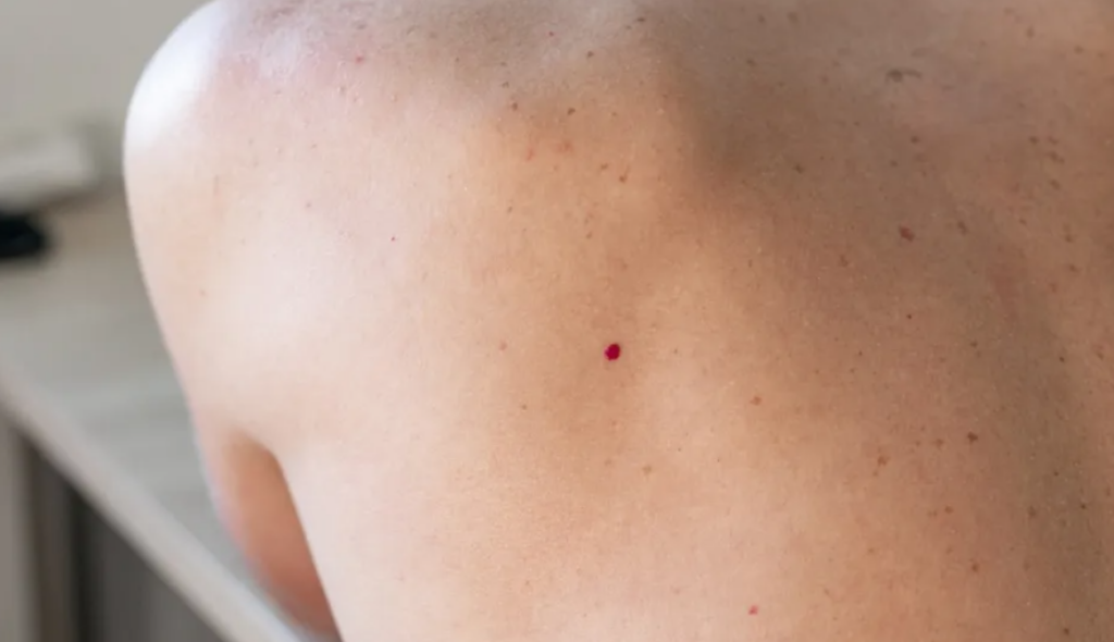 Red Moles on Skin - U.S. Dermatology Partners