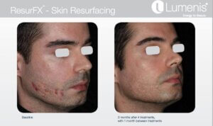 ResurFX Laser Treatment | U.S. Dermatology Partners