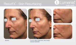 ResurFX Laser Treatment | U.S. Dermatology Partners