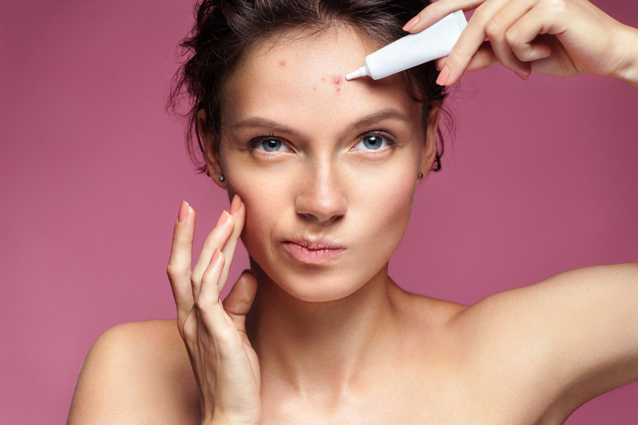 ACNE Face Mapping – What is Your Acne Trying to Tell You?