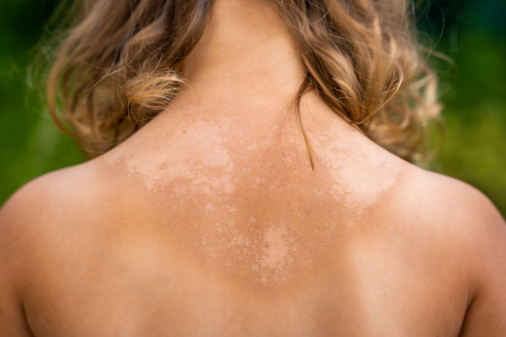 Treating Sunburn Blisters: Best Relief Methods