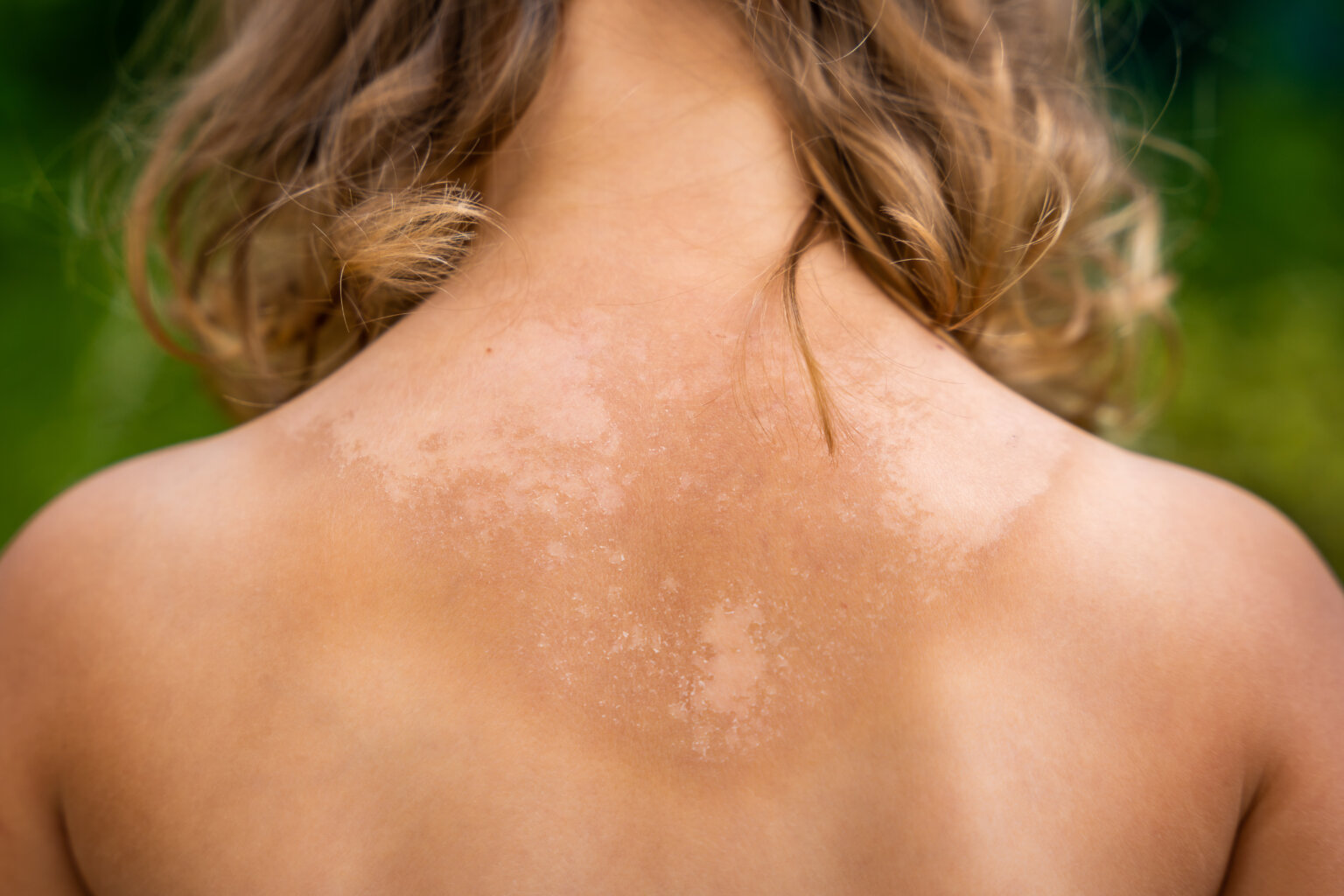 Treating Sunburn Blisters Best Relief Methods