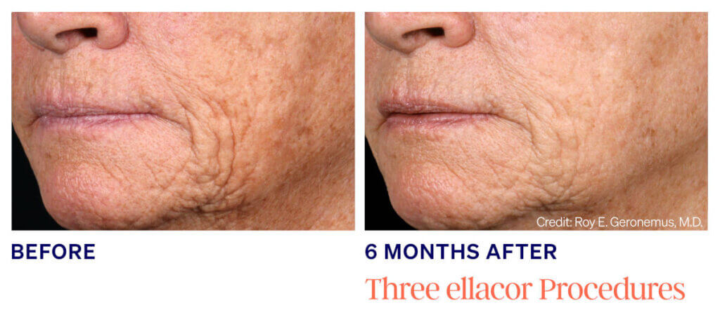 Ellacor Treatment | U.S. Dermatology Partners