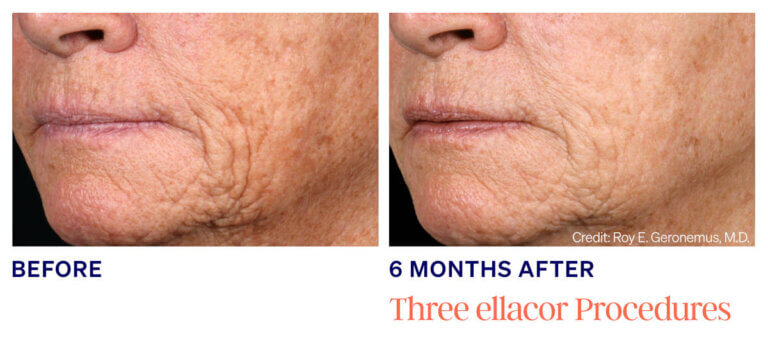 Ellacor Treatment | U.S. Dermatology Partners