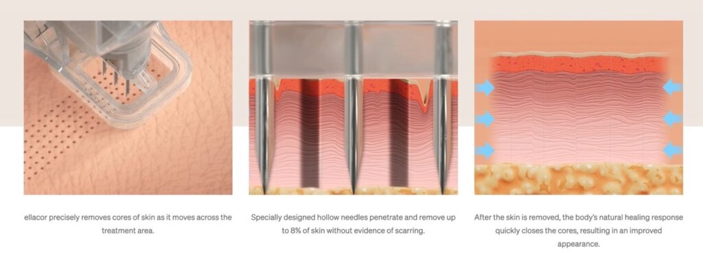 Ellacor Treatment | U.S. Dermatology Partners