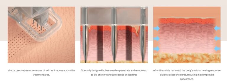 Ellacor Treatment | U.S. Dermatology Partners