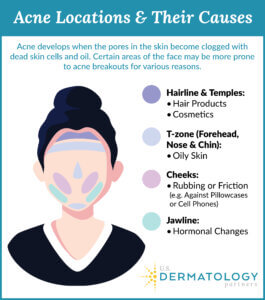ACNE Face Mapping – What is Your Acne Trying to Tell You?