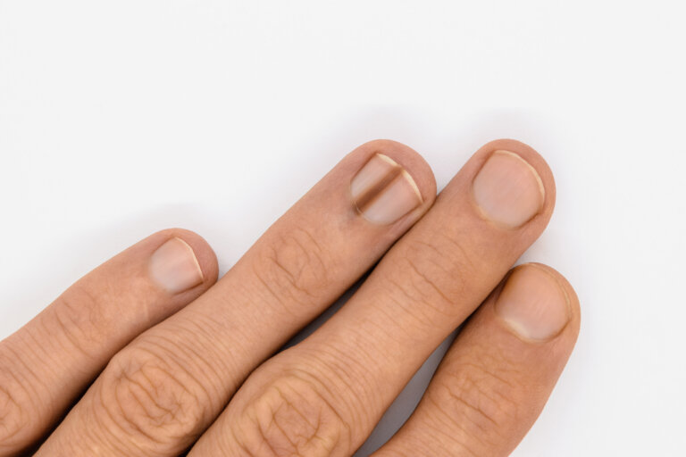 What is Nail Melanoma? Signs and Symptoms to Watch For