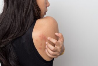 Skin Cancer or Rash? Early Signs You Shouldn’t Ignore - U.S ...