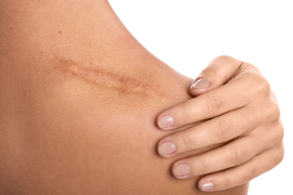 Laser Scar Removal & Other Dermatologist-Recommended Treatments - U.S. Dermatology Partners