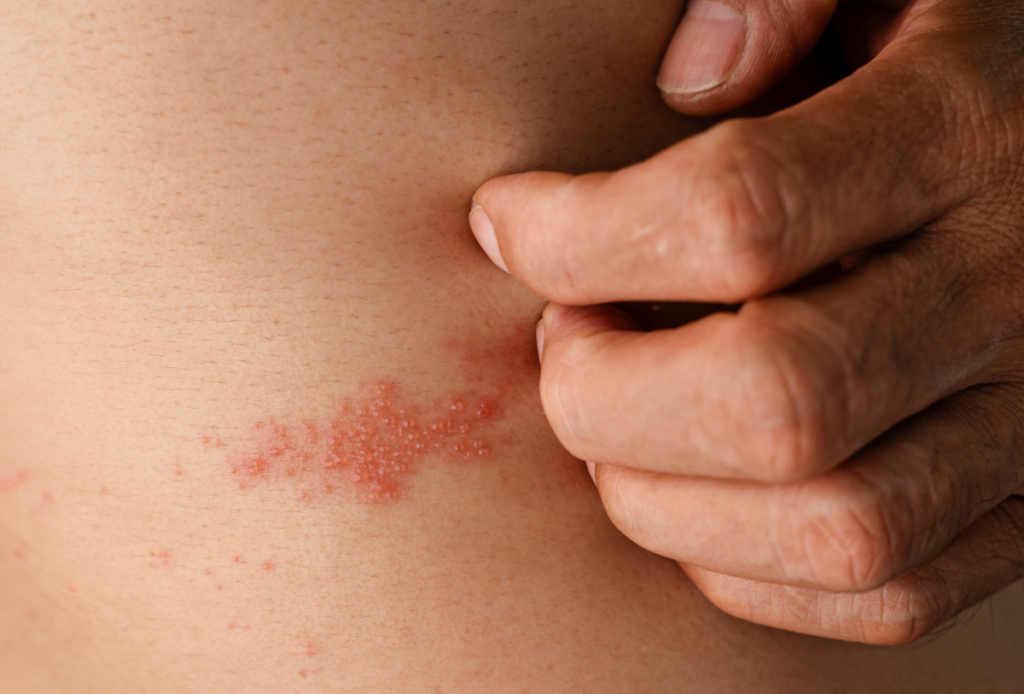 Bacterial Skin Rash? Why You Shouldn’t Ignore It - U.S. Dermatology ...